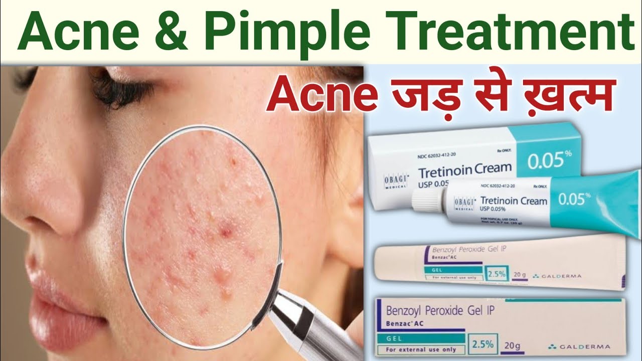 Acne treatment || acne & pimples treatment || acne & pimple cream for ...