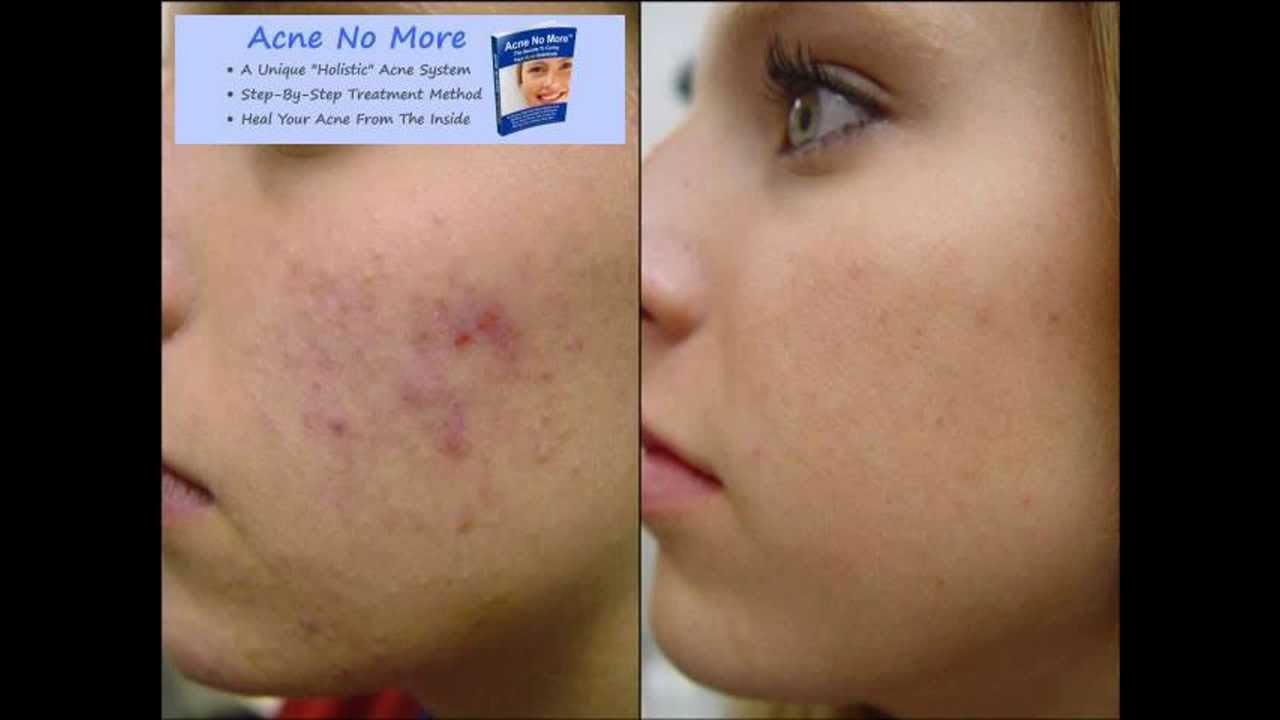 How To Get Rid Of Acne Fast And Keep It Gone - YouTube