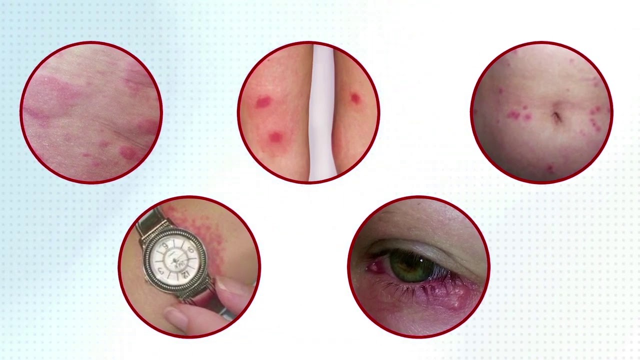 ANTILERGY_ELEMENTS WELLNESS - YouTube