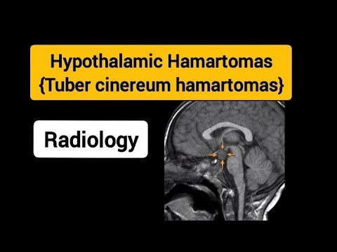 Hypothalamic Hamartomas - Radiology - Basic Radiology - YouTube