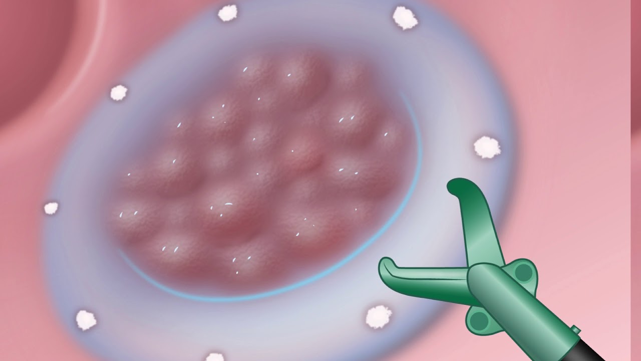 Colonoscopy: Hybrid EMR Steps Graphic Illustration - YouTube