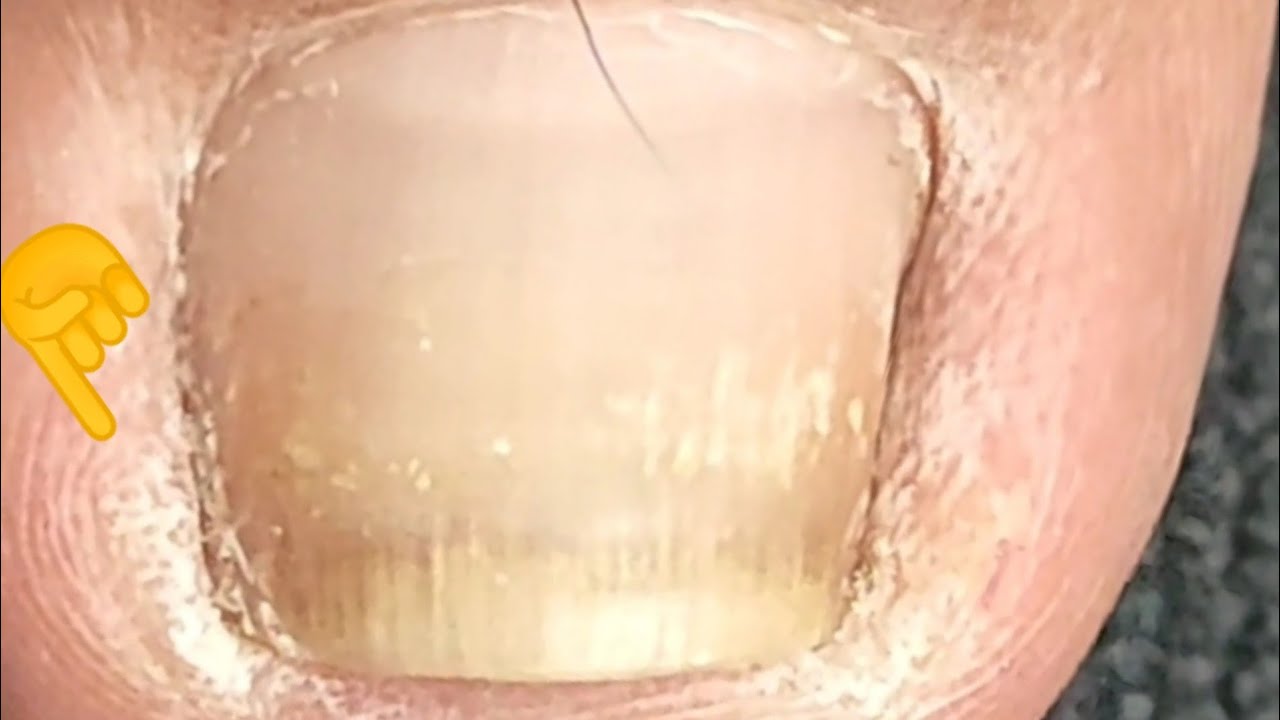 Outchhh Subrang napakadikit Ang kuko - YouTube