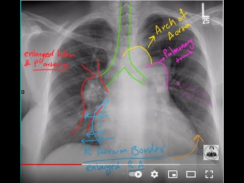 Radiology Course - Pulmonary Hypertension CXR Interpretation - YouTube
