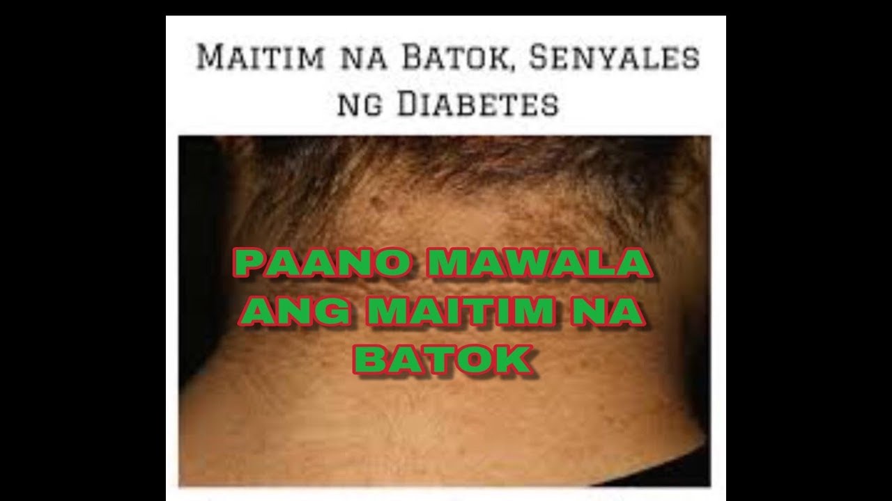 Maitim na batok,siko,singit, kili2//my solusyon - YouTube