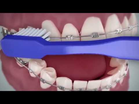 Brushing and Flossing With Braces Spanish - YouTube