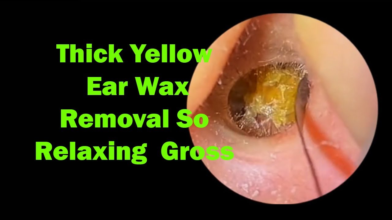 Thick Yellow Ear Wax Removal | So Relaxing & Gross - YouTube