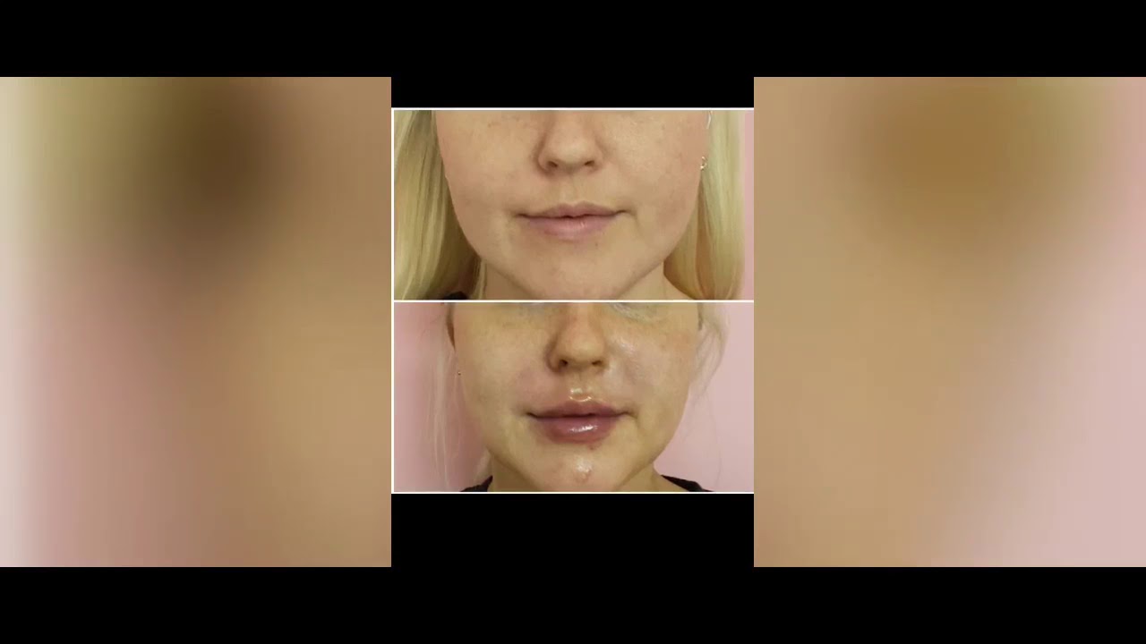 All NATURAL "lip flip" w/ PDO threads @ Generations Skin Care - YouTube