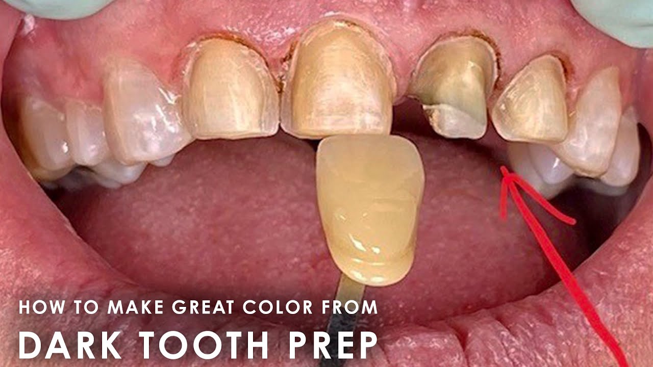 How to make great Color from Dark Tooth Prep - YouTube