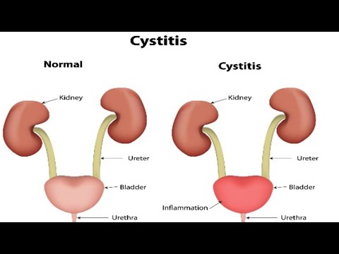 Cystitis||Bsc nursing 2nd year||medical surgical management - YouTube
