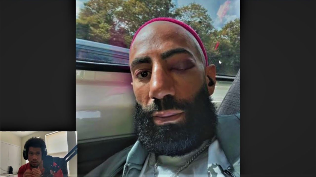Fousey Broke His nose!!! - YouTube