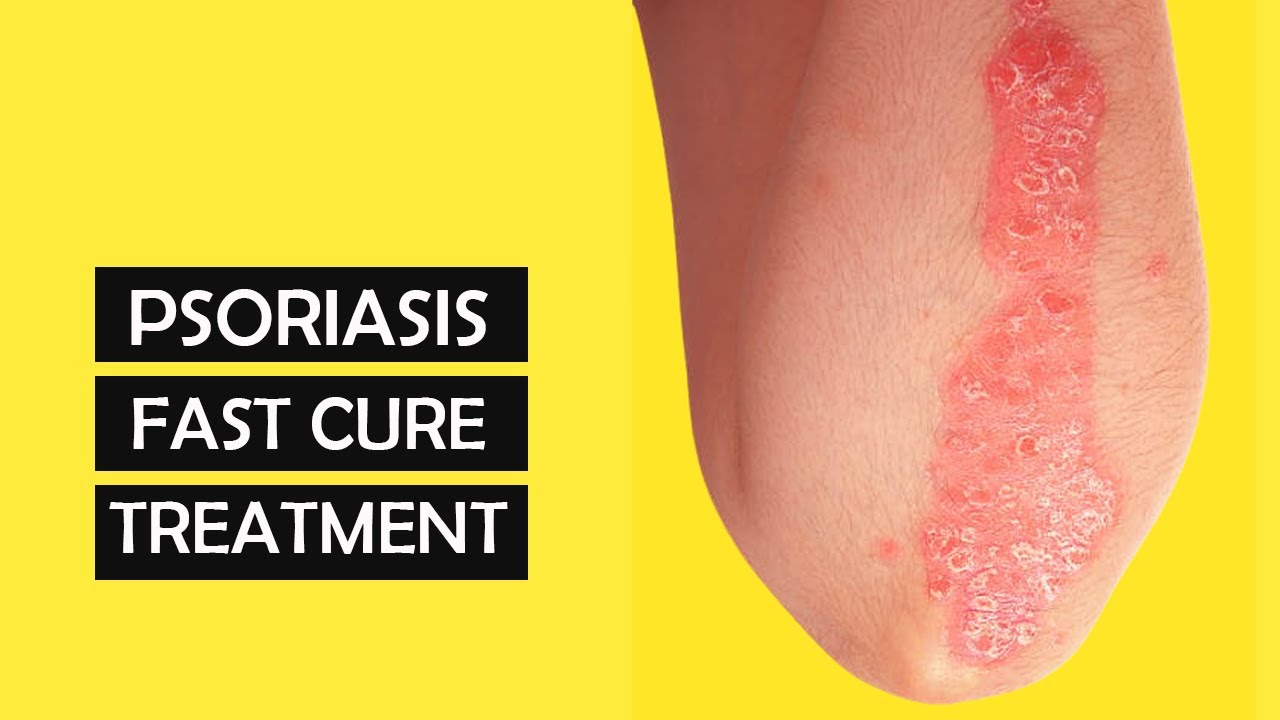 Psoriasis Treatment: How To Cure Psoriasis Fast | Psoriasis And ...