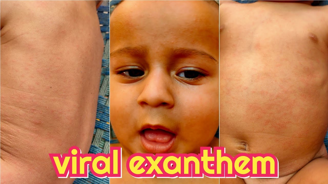 Baby has viral exanthem || viral rashes - YouTube