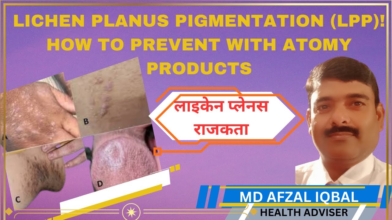 Lichen Planus Pigmentation (LPP)! How to Prevent with Atomy Products ...