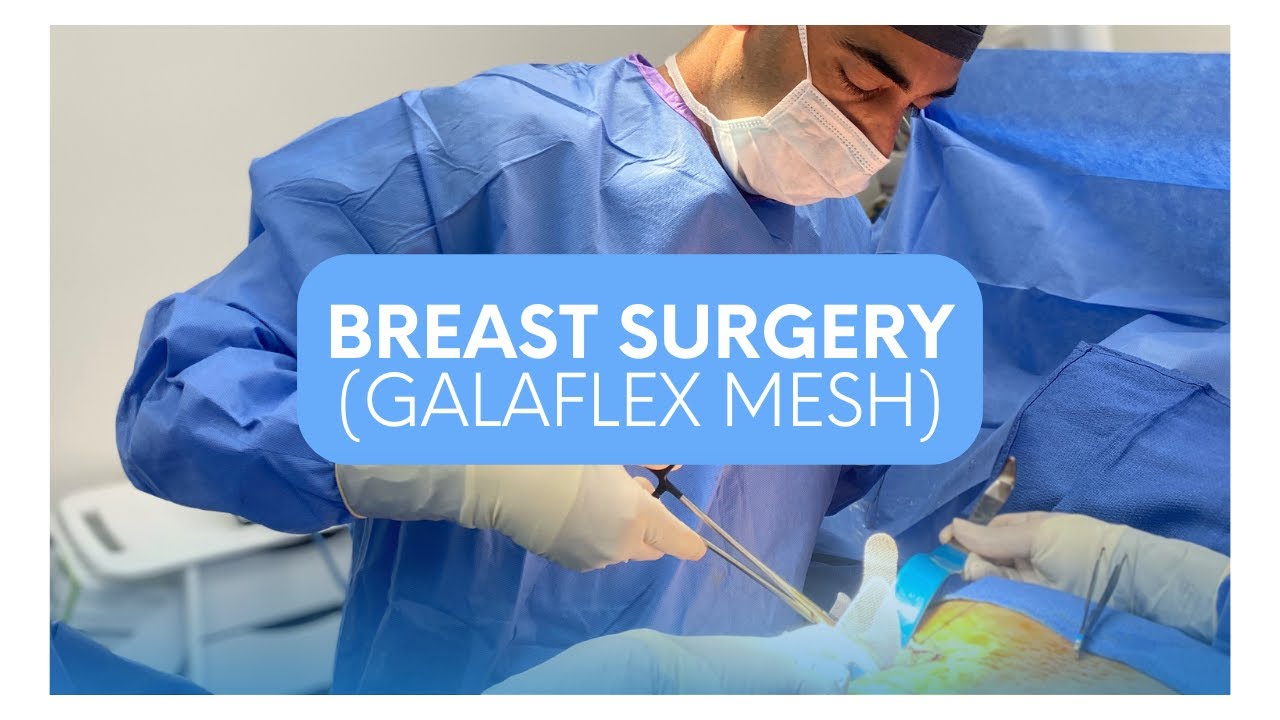 Breast surgery with Galaflex Mesh with Dr. Zuri in Miami | Zuri Plastic ...