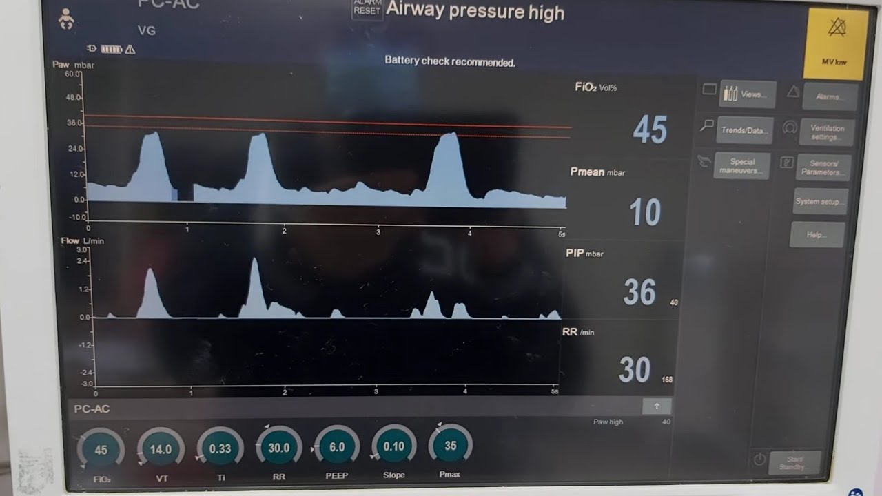 workshop 70 How to calculate the oxygenation index OI ? indicator ...