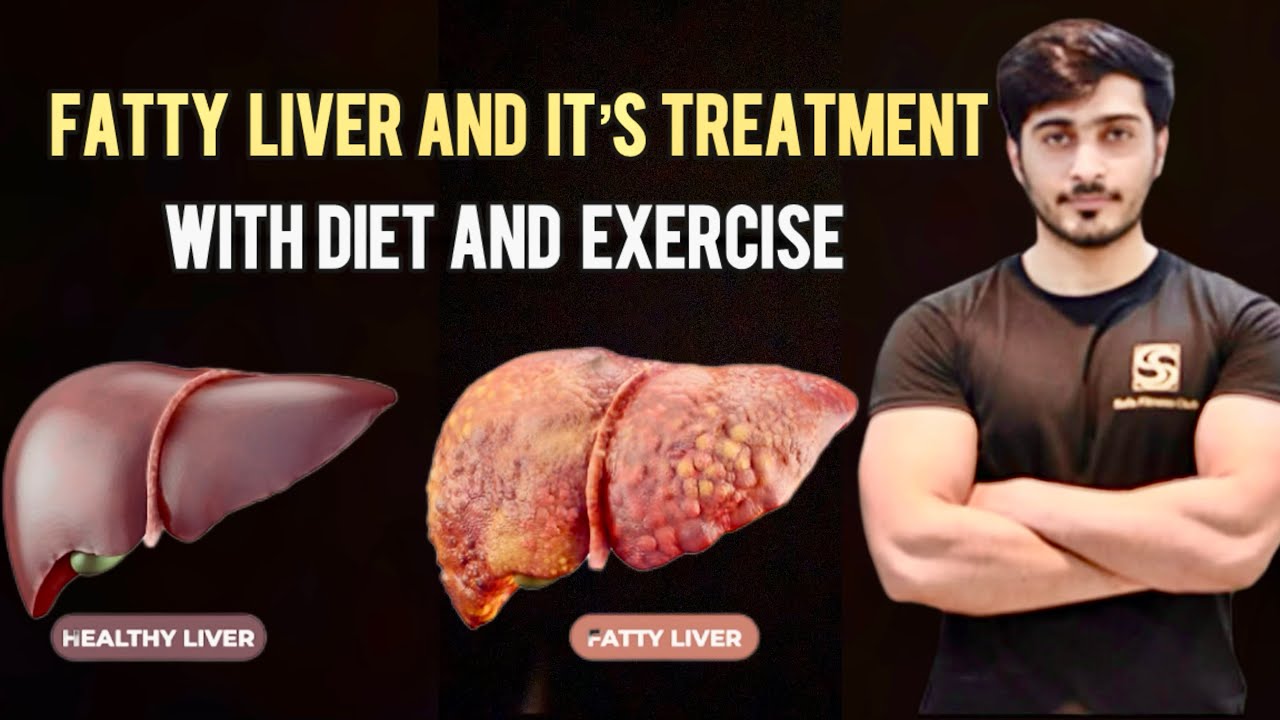 FATTY LIVER AND ITS TREATMENT WITH DIET AND EXERCISE - YouTube