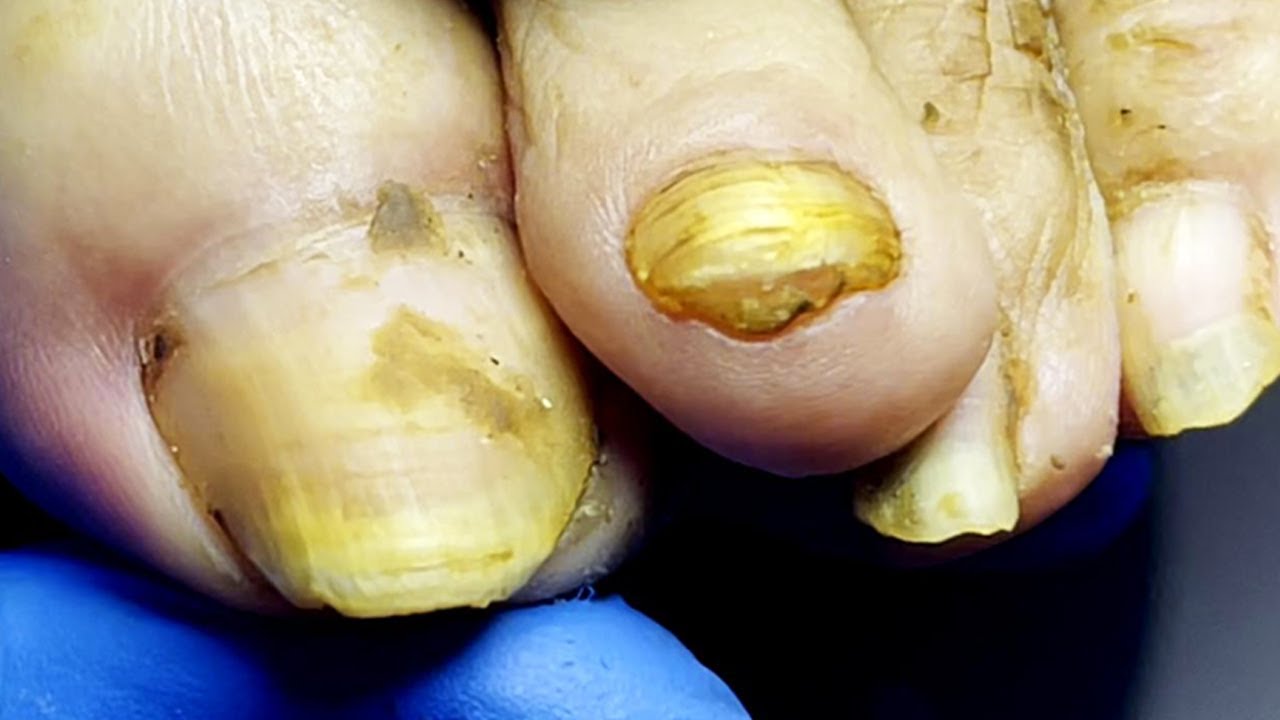 Dirty toenails trimmed, perfect pedicure~【Foot Scalpel】 - YouTube