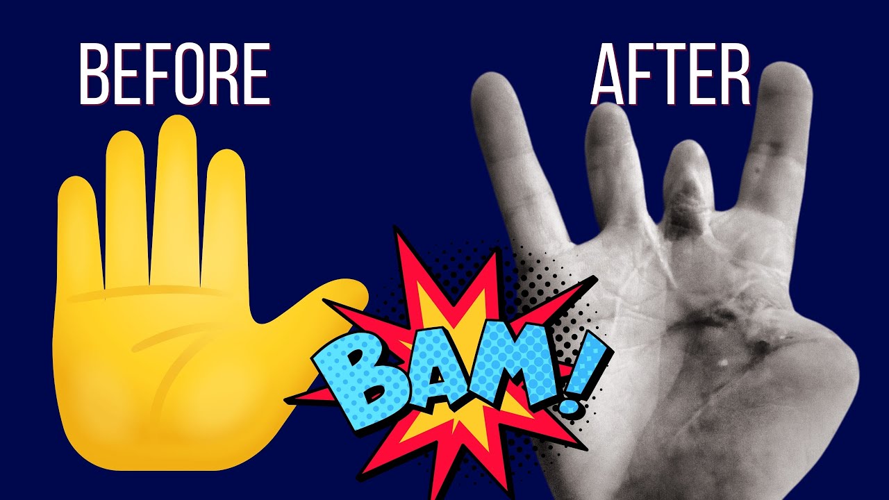 Trauma of Losing My Fingers and... - YouTube