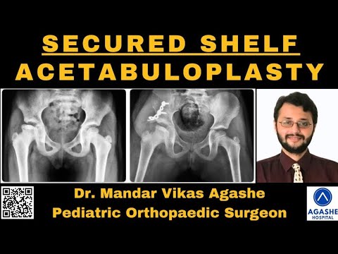 Secured Shelf Acetabuloplasty - YouTube