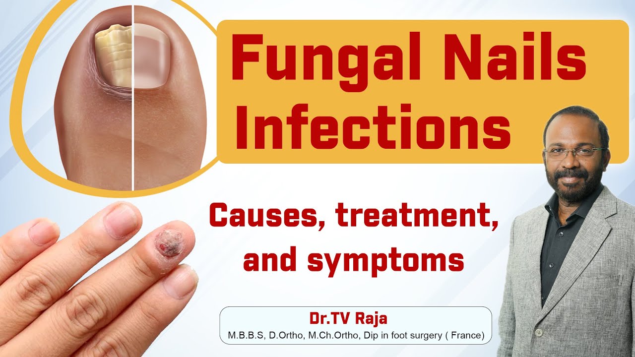 Fungal Nails Infections | Causes | Treatment | Symptoms - Dr.TV Raja ...
