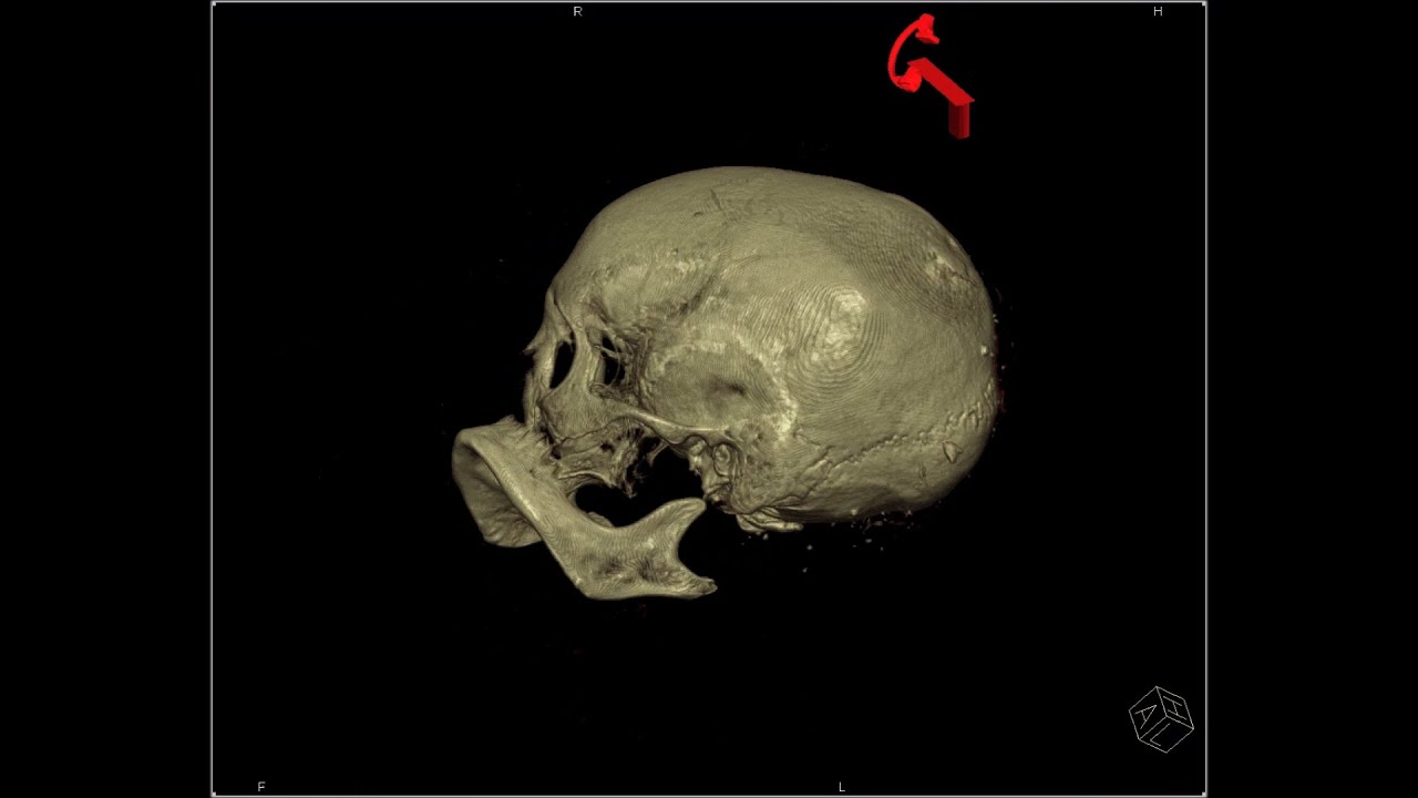 Stanford Radiologists Scan Egyptian Mummy for Clues to Its Origin - YouTube