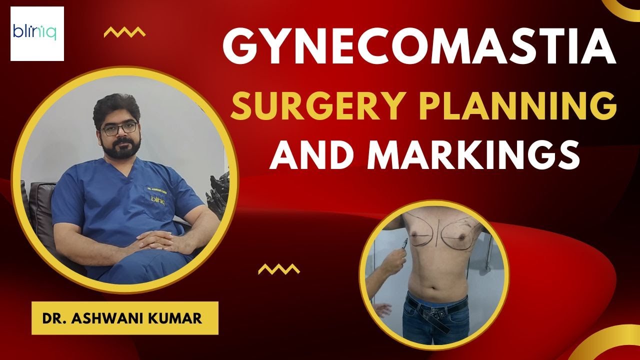 Gynecomastia Surgery Planning And Markings | Male Breast Reduction ...