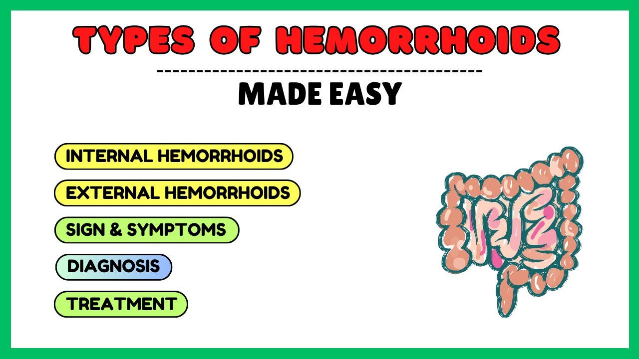 Types of piles (hemorrhoids), internal and external hemorrhoids ...