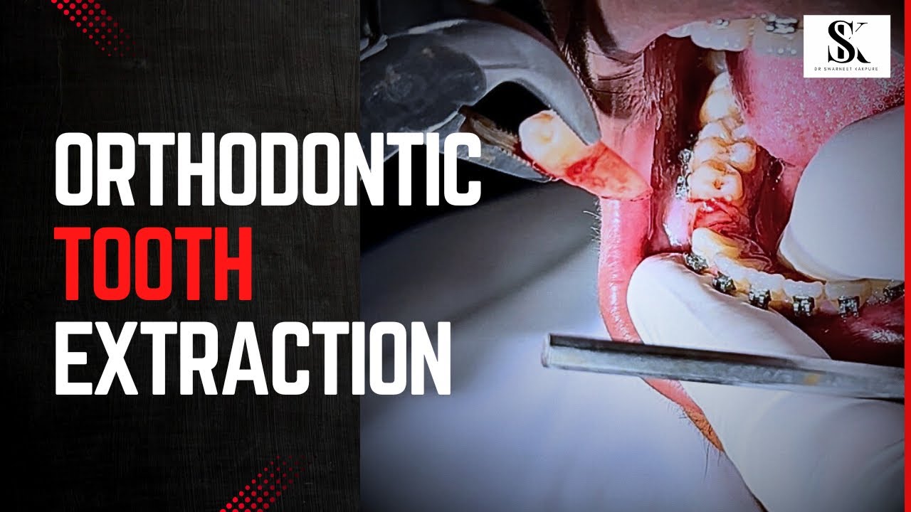 Ortho Premolar tooth extractions | Quick & Easy - YouTube
