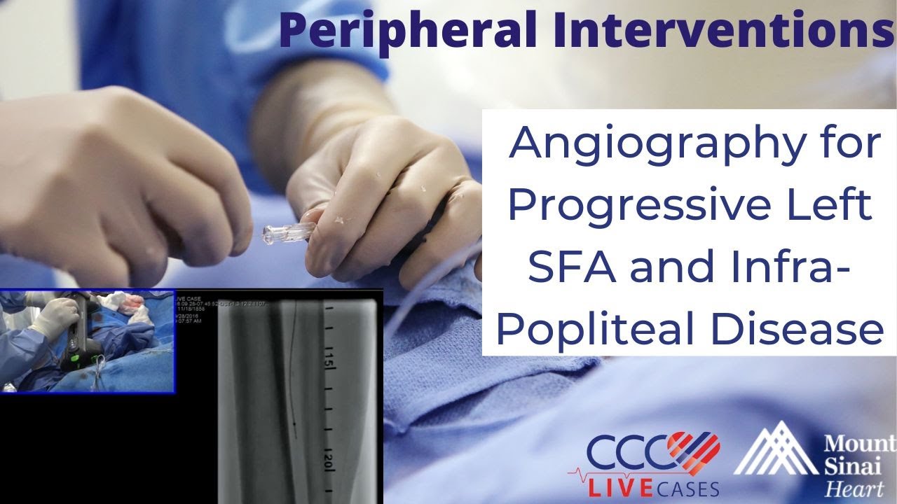 Angiography for Progressive Left SFA and Infra-Popliteal Disease ...