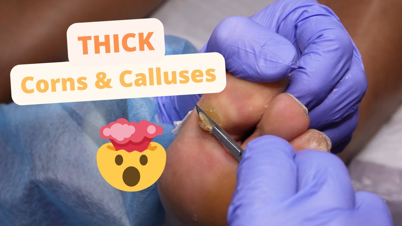 THICK Corns & Callus Debridement! - YouTube