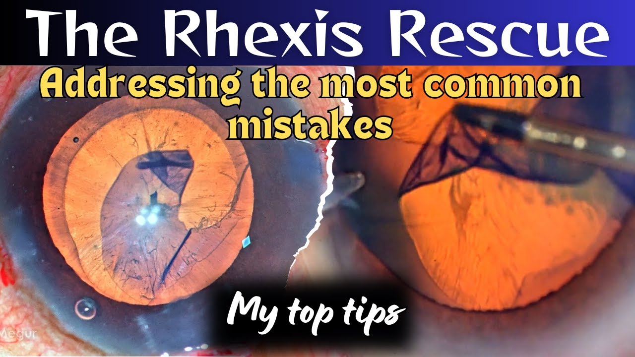 THE RHEXIS RESCUE : My top pearls, Addressing the most common mistakes ...