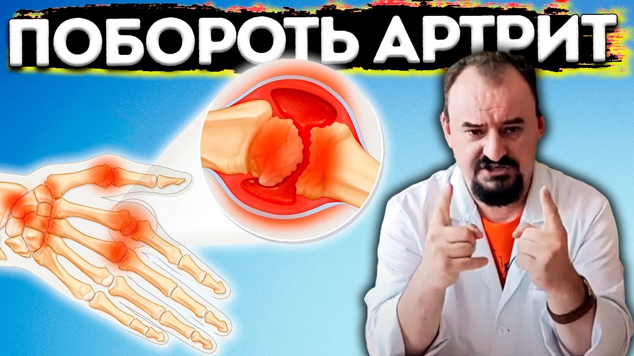 Надежный способ ВЫЛЕЧИТЬ ревматоидный артрит Youtube