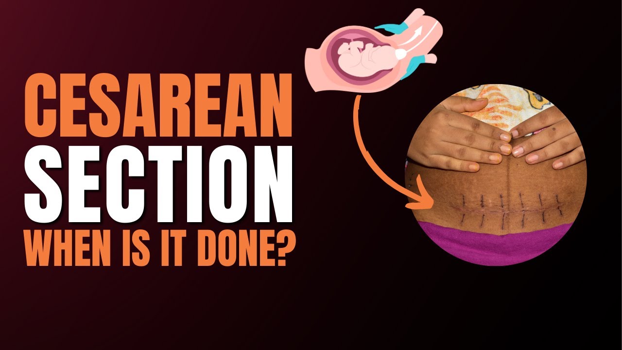 Why Are C-Sections so Common? Find Out the most common reasons - YouTube