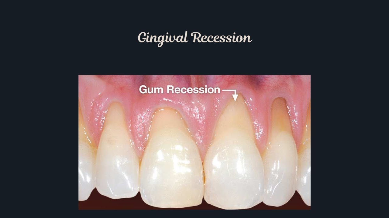 Gingival recession || BDS# periodontics - YouTube