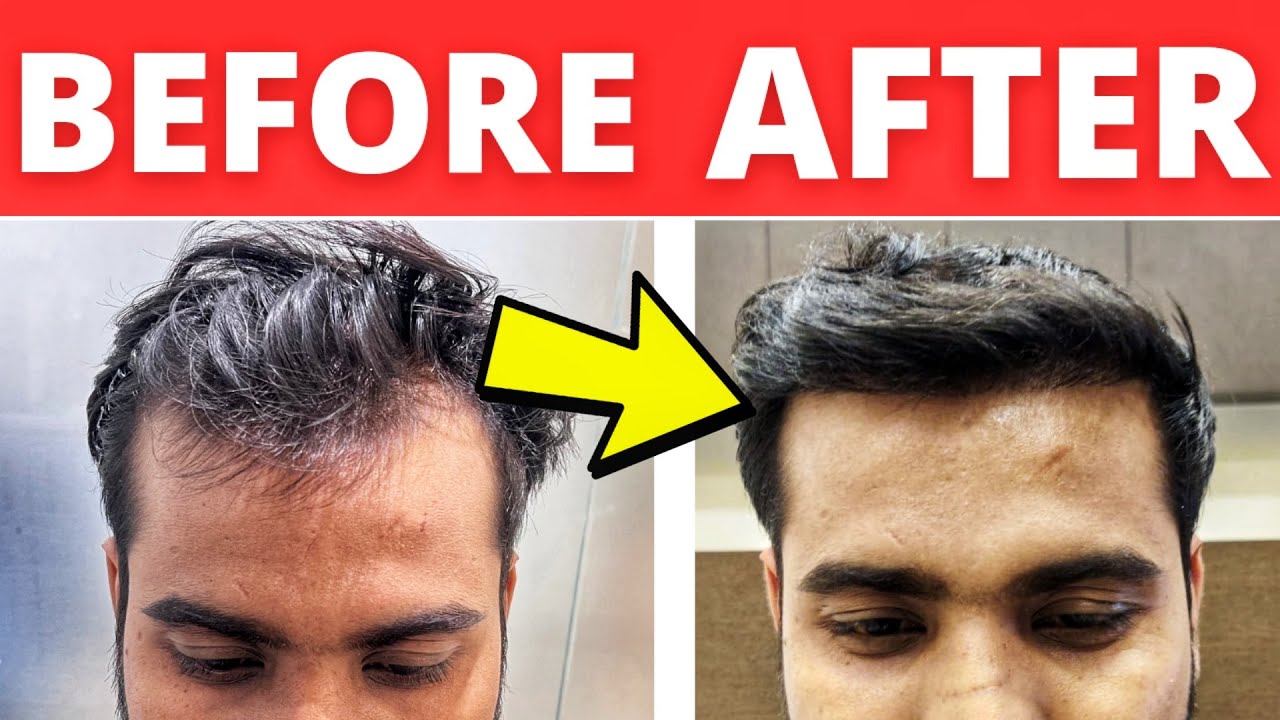 5 Months Hair Transplant Result Journey | FUE Hair Transplant Results After Months - YouTube