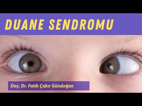 Duane Sendromu Nedir? Nasıl Tedavi Edilir?