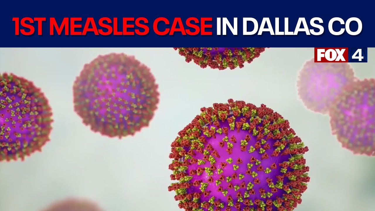 1st measles case confirmed in Dallas County - YouTube