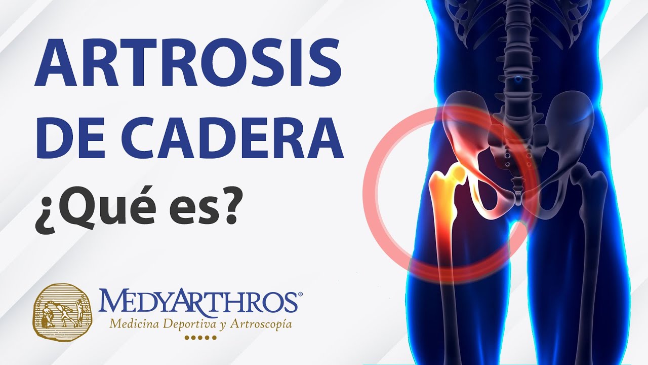 Artrosis de Cadera ¿Qué es? (Parte 2) | Clínica de Cadera | Medyarthros ...