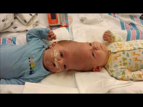 Doctors perform risky surgery to separate conjoined twins