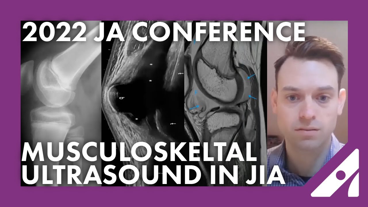 Musculoskeletal Ultrasound in Diagnosis and Treatment of JIA - YouTube