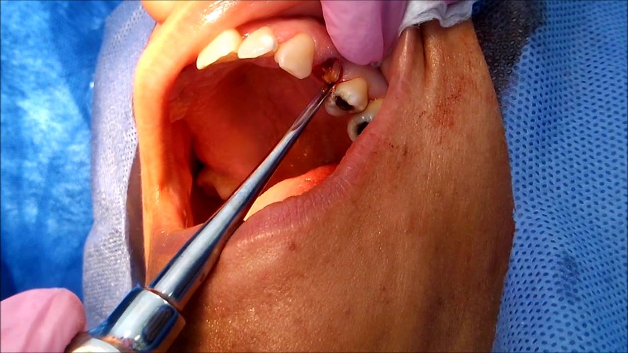 extraccion resto radicular #24 - YouTube