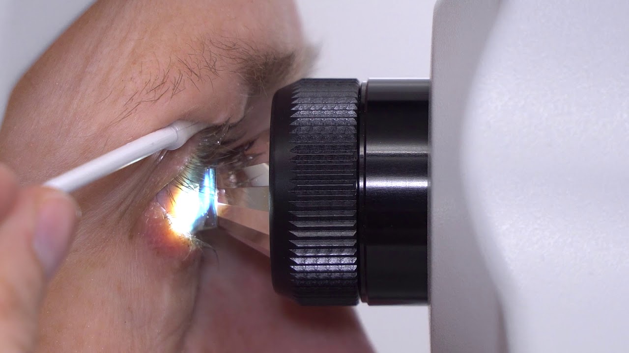 Automatische Gonioskopie mit dem OCULUS/NIDEK GS-1 ...
