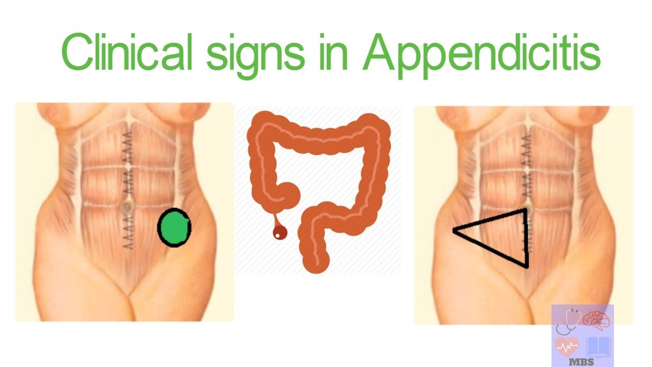 Appendicitis Clinical Examinations Medical Signs Mbs Youtube