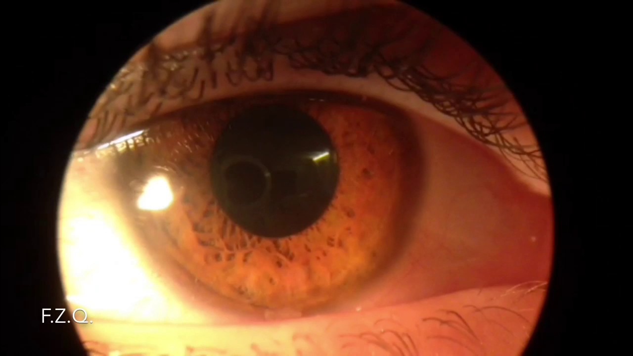 Parpadeo incompleto - YouTube