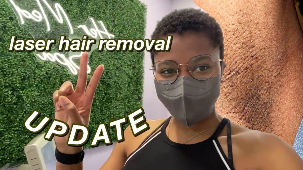MY LASER HAIR REMOVAL EXPERIENCE ON DARK SKIN | AFTER SESSION RECAPS ...