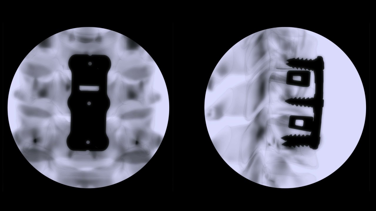 CoreLink Terrace Anterior Cervical Plate and SureSize Interbody Cage ...