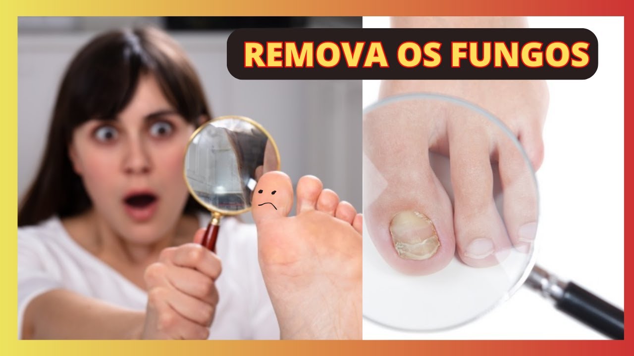 Acabe com os FUNGOS nas UNHAS em 1 DIA! || 9 REMÉDIOS NATURAIS para ...