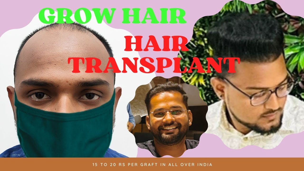 Amazing High Density Hair Transplant Journey Of 9 Months haircare amazing-high-density-hair-transplant-journey-of-9-months-haircare