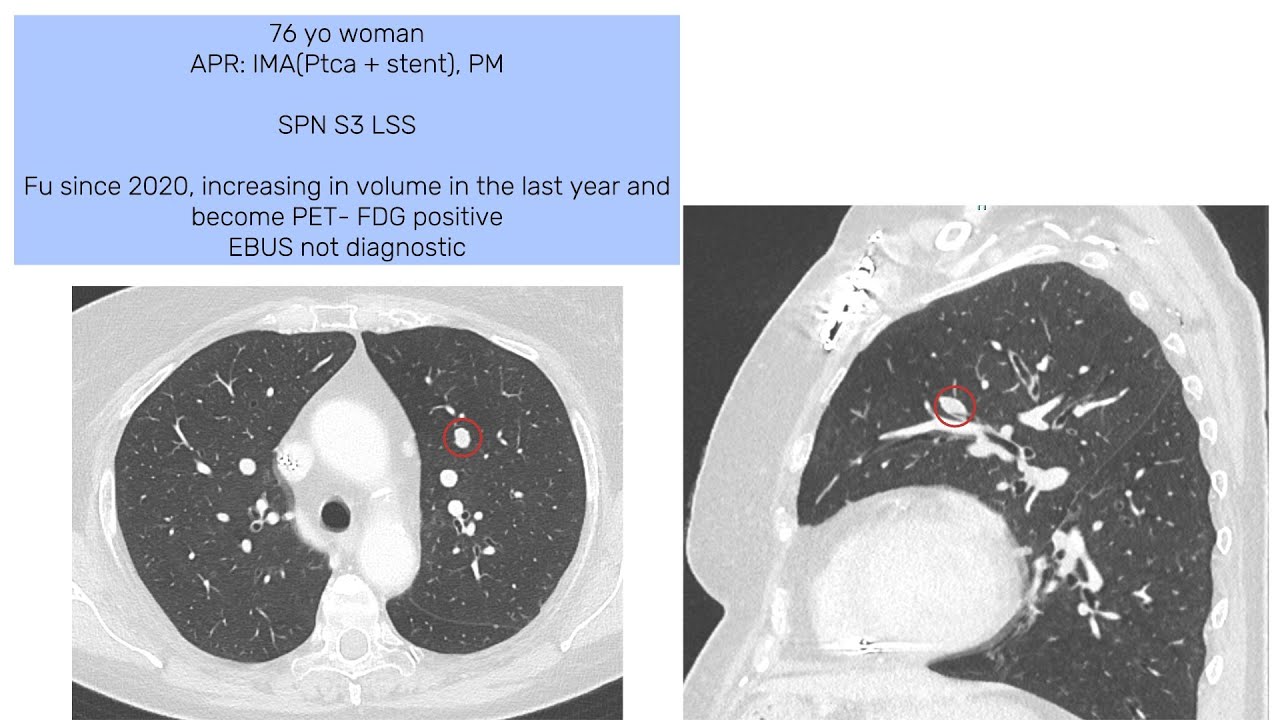 Robotic S3 Upper left lobe segmentectomy (Ventral Segment) - YouTube