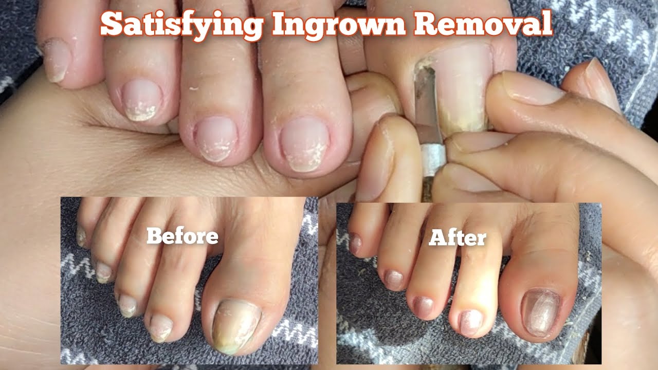 Satisfying Cleaning | Ingrown Removal | Pedicure#40 - YouTube